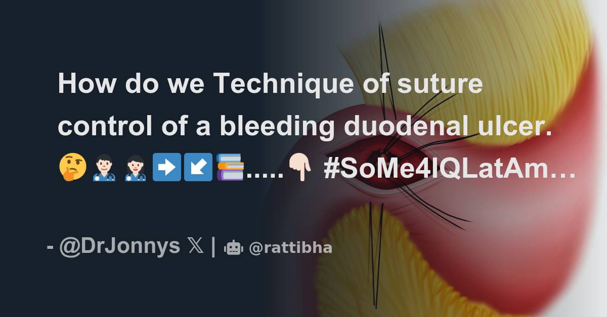 How do we Technique of suture control of a bleeding duodenal ulcer.🤔👨🏻 ...