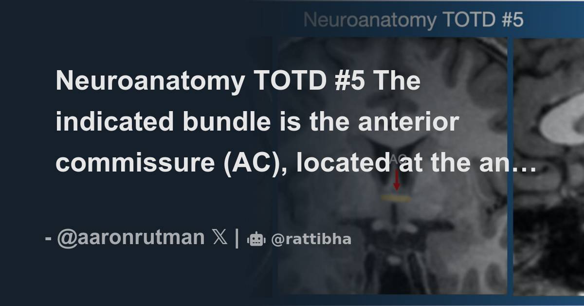 Neuroanatomy TOTD #5 The indicated bundle is the anterior commissure ...