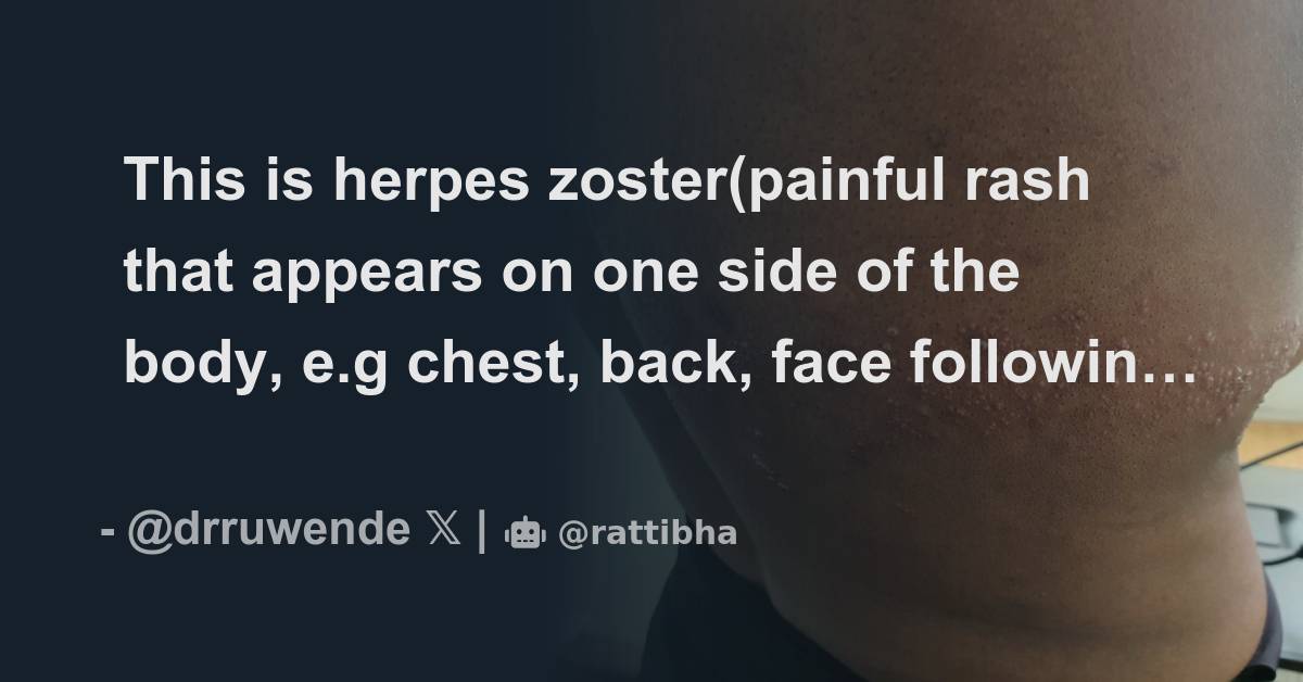 This is herpes zoster(painful rash that appears on one side of the body ...
