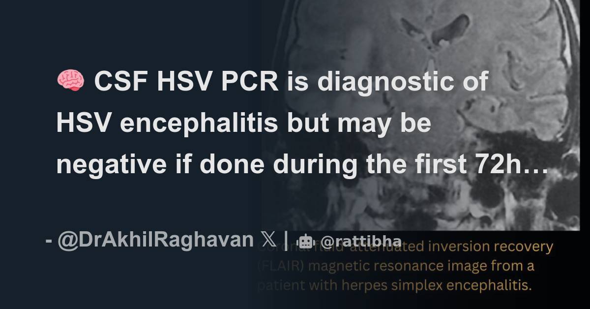 🧠 CSF HSV PCR is diagnostic of HSV encephalitis but may be negative if ...