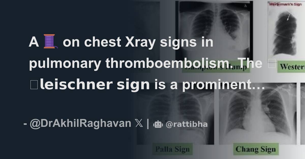 A 🧵 on chest Xray signs in pulmonary thromboembolism. - Thread from Dr ...