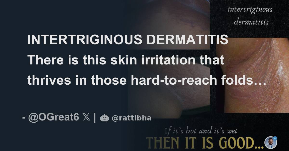 INTERTRIGINOUS DERMATITIS There is this skin irritation that thrives in ...