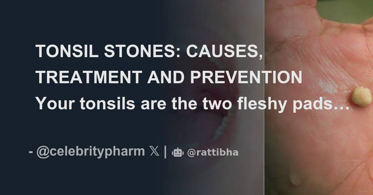 TONSIL STONES: CAUSES, TREATMENT AND PREVENTION Your tonsils are the ...