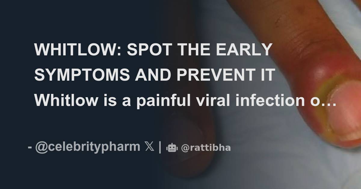 WHITLOW: SPOT THE EARLY SYMPTOMS AND PREVENT IT Whitlow is a painful ...