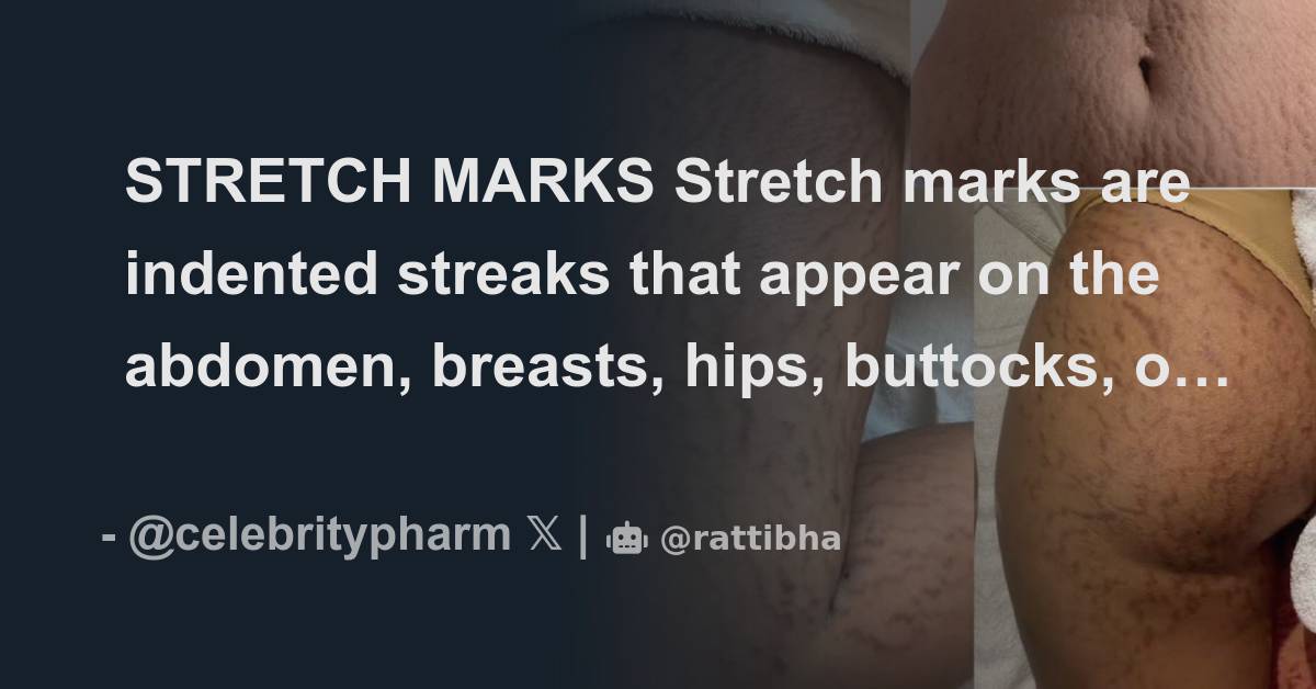 STRETCH MARKS Stretch marks are indented streaks that appear on the ...